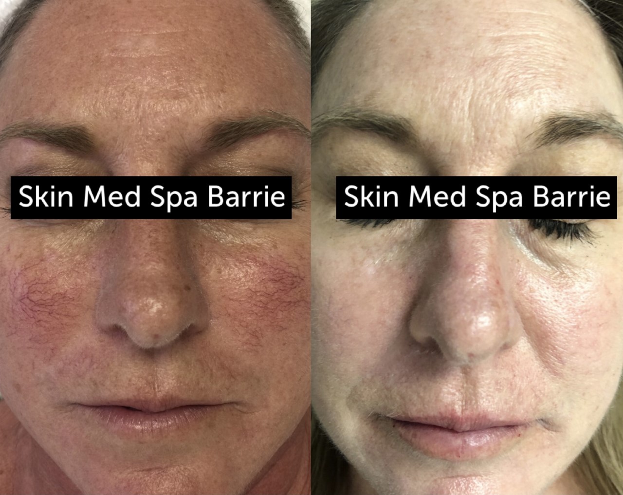 Intense Pulsed Light (IPL) - Skin Med Spa Simcoe