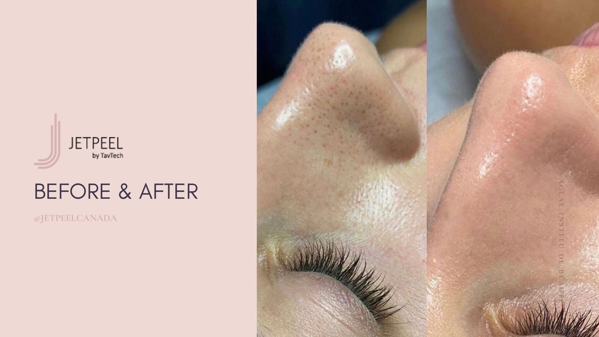 JetPeel - Skin Med Spa Simcoe